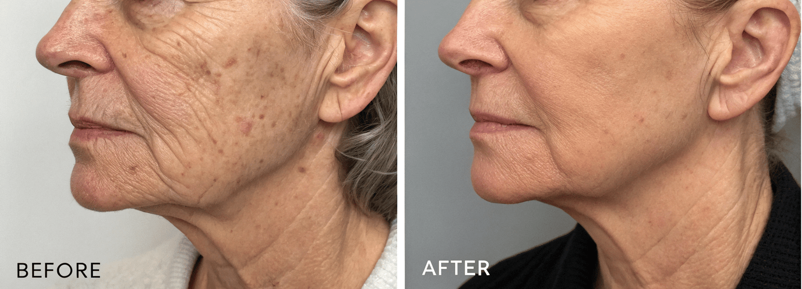 Specialty: Fractional CO2 Laser Before and After